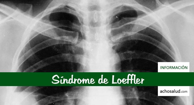 Síndrome de Loeffler: causas y tratamientos clave