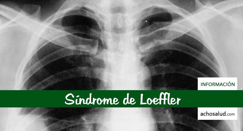 Síndrome de Loeffler: causas y tratamientos clave
