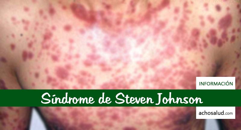 Síndrome de Steven Johnson: causas y tratamientos